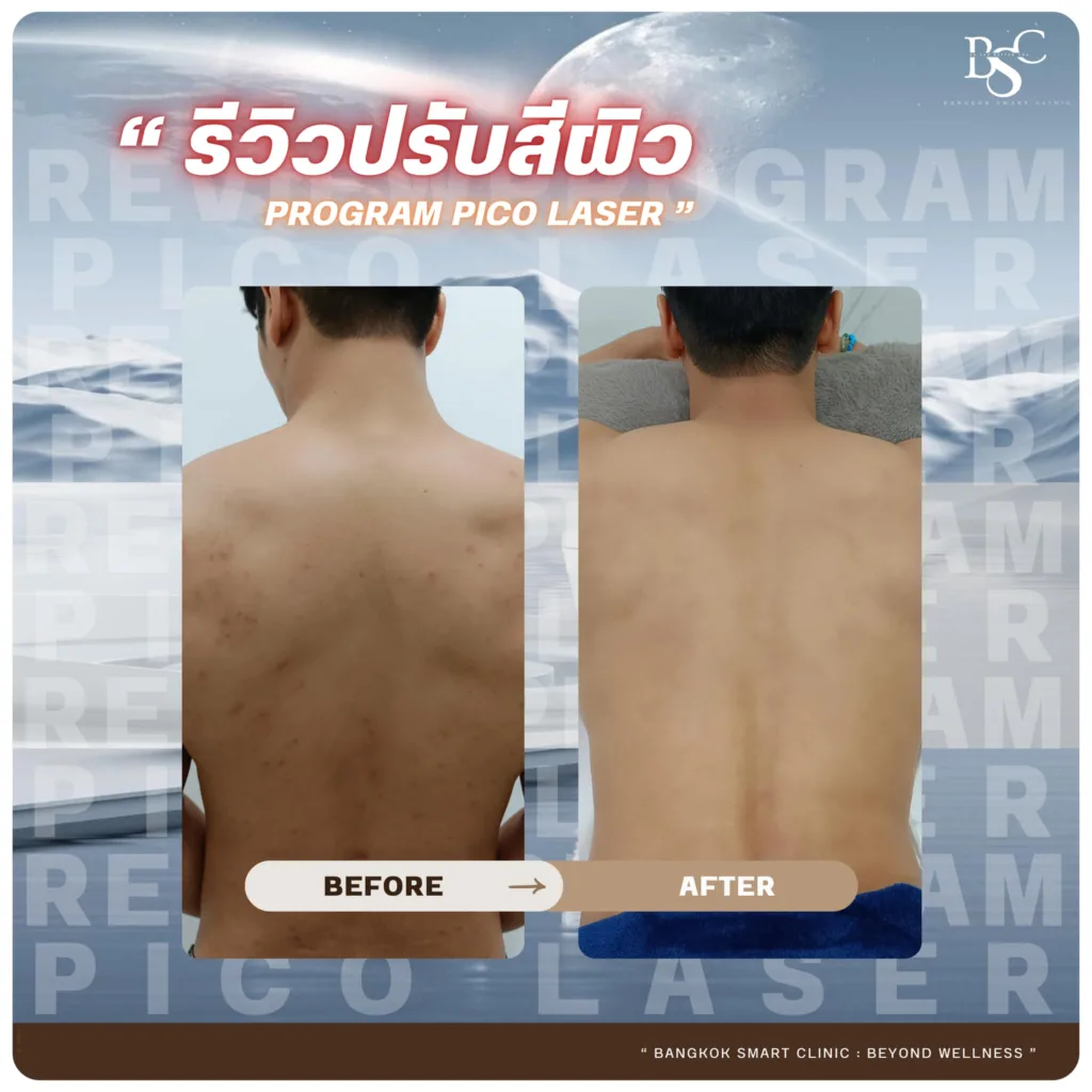 คืนความมั่นใจให้ผิวคุณ ด้วย Program Pico Laser - Bangkok Smart Clinic: Beyond Wellness